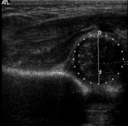 Developmental Dysplasia of the Hips (DDH) | HubPages