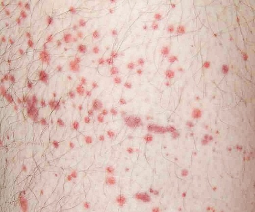 Thrombocytopenia, Low Platelet Count, and Bleeding Problems | YouMeMindBody