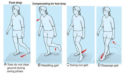 Living with Foot Drop | hubpages