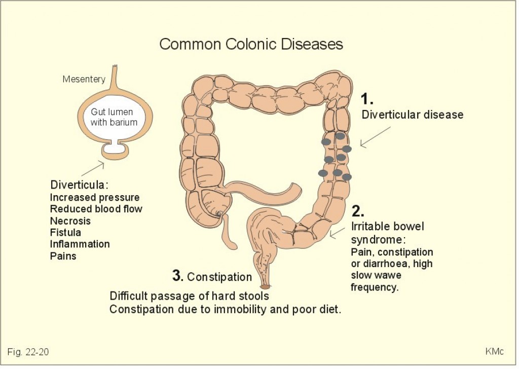 Discovery: Fasting Stops Peristalsis Giving Colon a Rest | HubPages