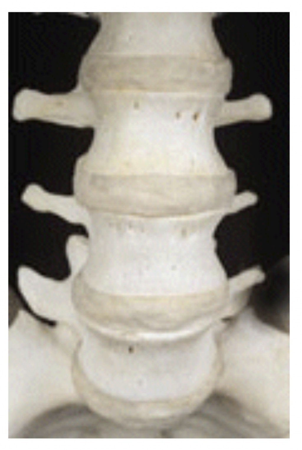 Orthopedic Disk Fusion - Allow Fusion on your spine or not | HubPages