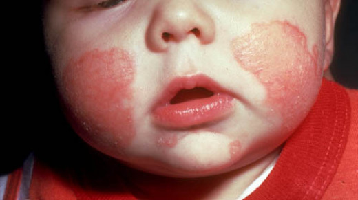 Infant Rash And More: The Variations Of Dermatitis Atopica Symptoms ...