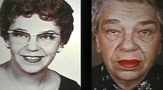 Acromegaly Before And After