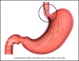 Esophageal Stricture