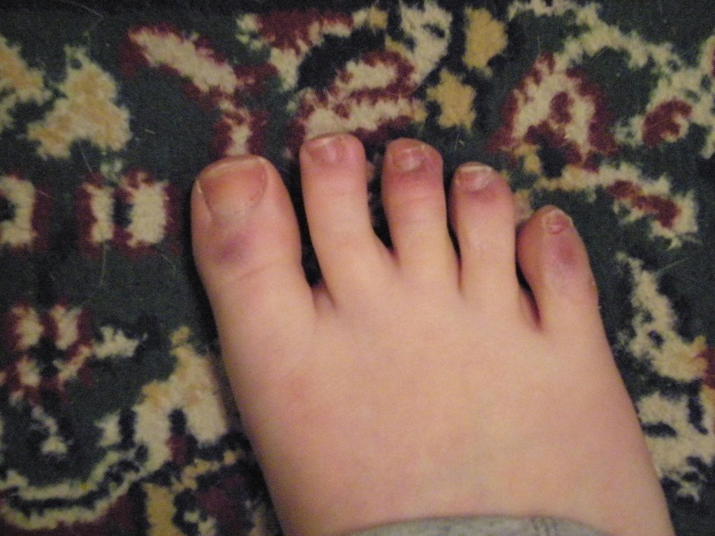 Vasculitis: A Diagnosis In Progress | hubpages