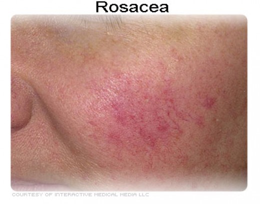 What You Need to Know about Rosacea | HubPages