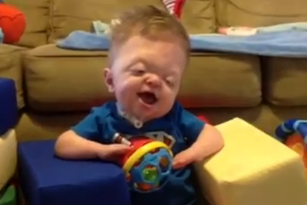 Apert Syndrome Causes Symptoms Treatment Apert Syndrome