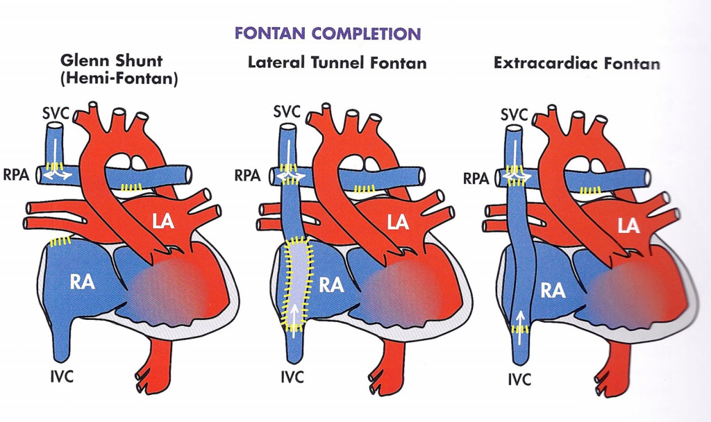Left To Right Shunt Lesions Atrial Septal Defect Asd Hubpages