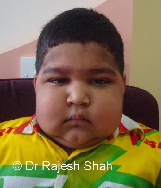 General Clinical Features And Special Types Of Nephrotic Syndrome ...